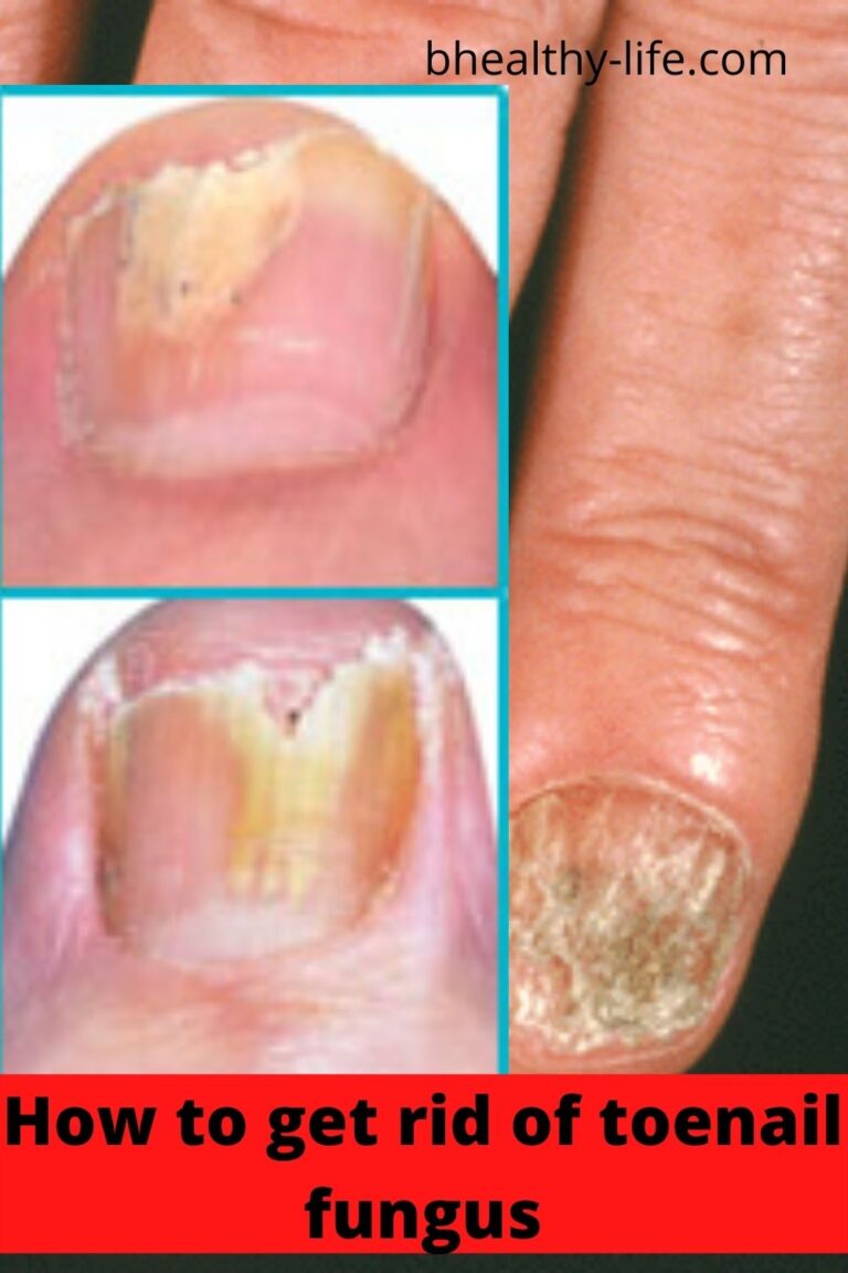 How to get rid of toenail fungus | Toenail Fungus Causes and Treatment ...